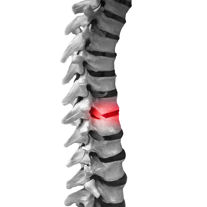 Low Back Pain & Disc Injury Program - Strength Therapy